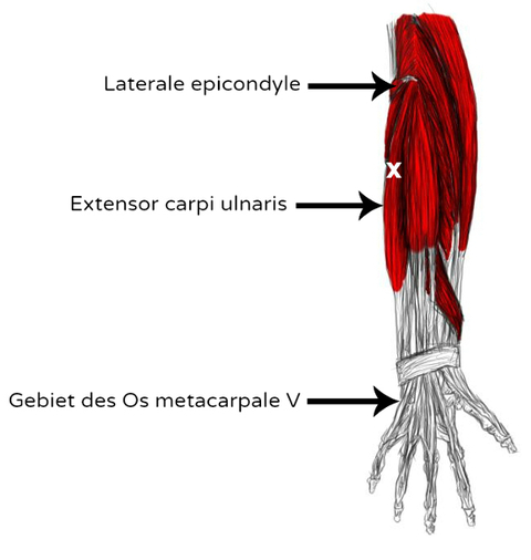Extensor carpi ulnaris Schmerzen und Triggerpunkte selbst behandeln