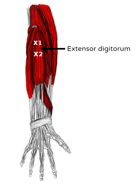 Extensor digitorum Schmerzen und Triggerpunkte selbst behandeln