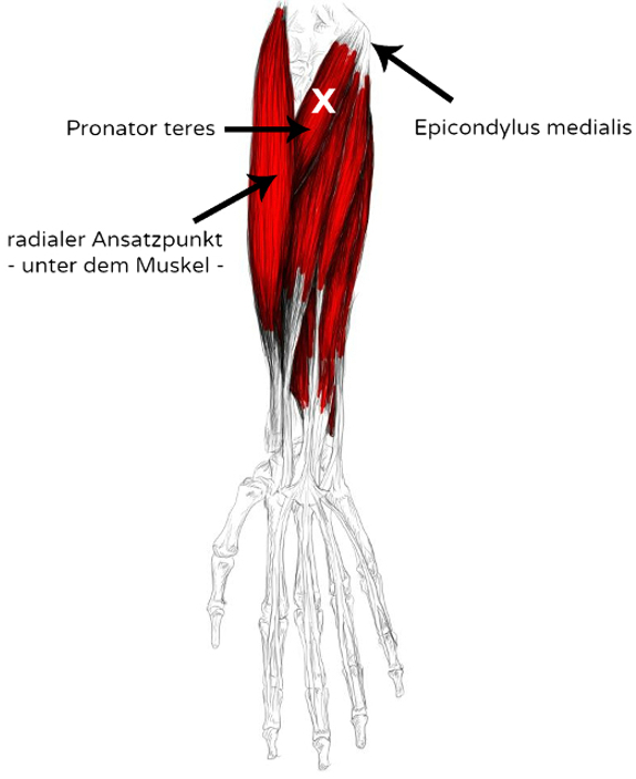 Pronator teres Schmerzen & Triggerpunkte selber behandeln
