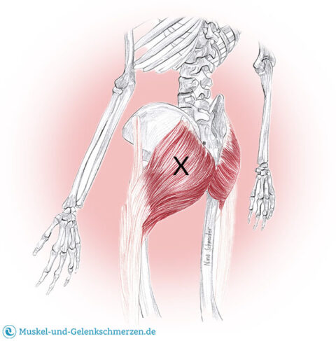 Gluteus maximus Schmerzen und Triggerpunkte selbst behandeln