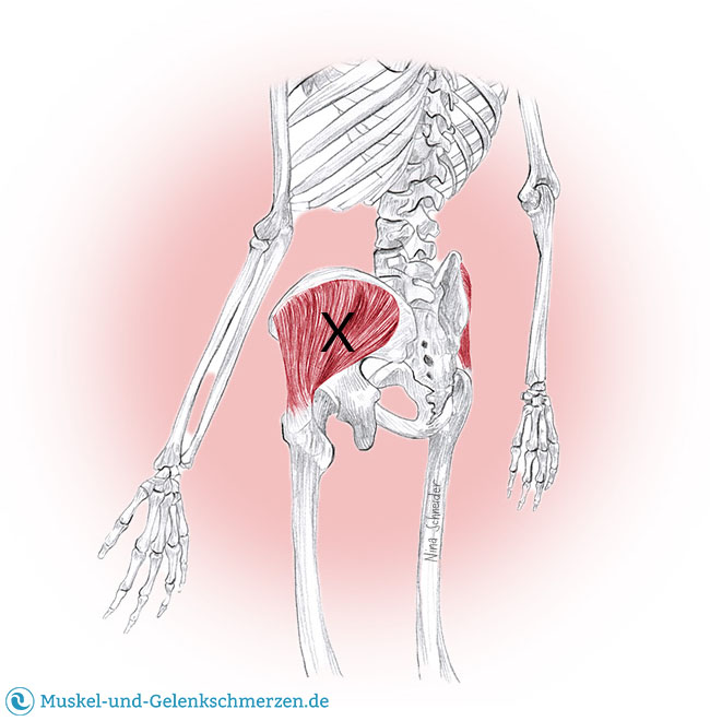 Gluteus medius Schmerzen und Triggerpunkte selbst behandeln