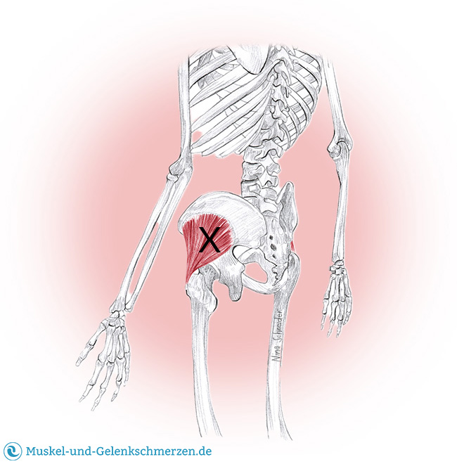 Gluteus minimus Schmerzen und Triggerpunkte selbst behandeln