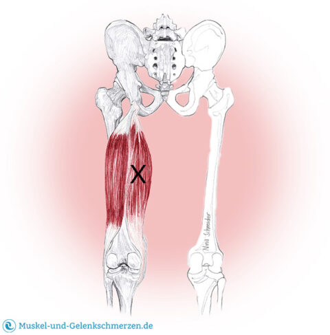 Ischiocrurale Muskulatur: Schmerzen und Triggerpunkte selbst behandeln