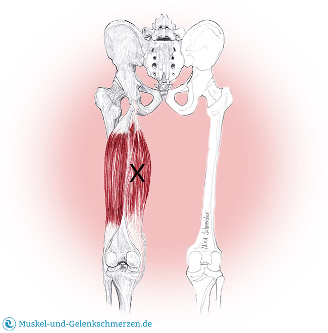 Ischiocrurale Muskulatur: Schmerzen und Triggerpunkte selbst behandeln