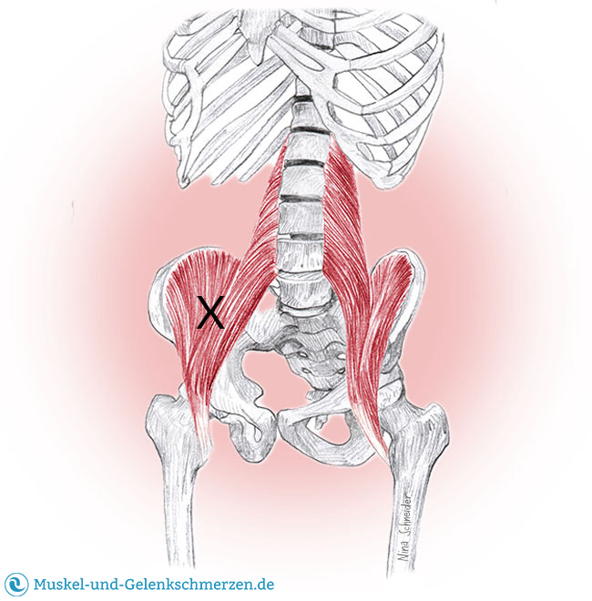 Lerne Iliopsoas Schmerzen und Triggerpunkte selbst zu behandeln