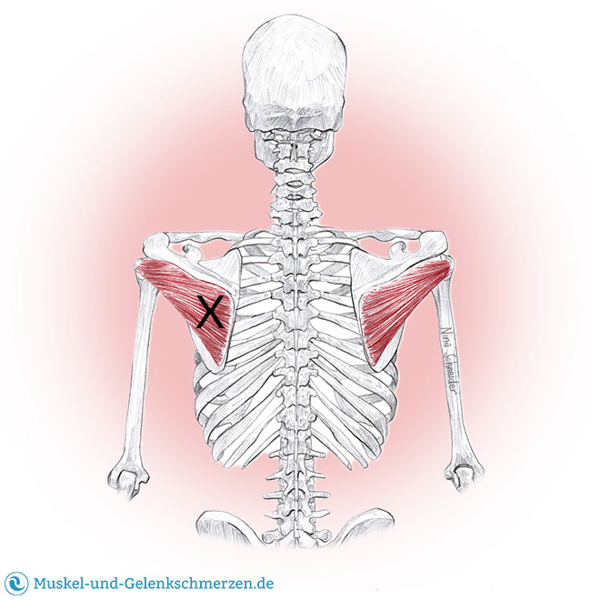 Infraspinatus Schmerzen und Triggerpunkte selbst behandeln