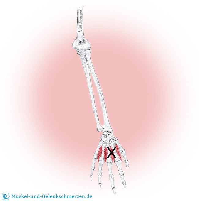Interossei, Lumbricales und Abductor digiti Schmerzen und Triggerpunkte ...