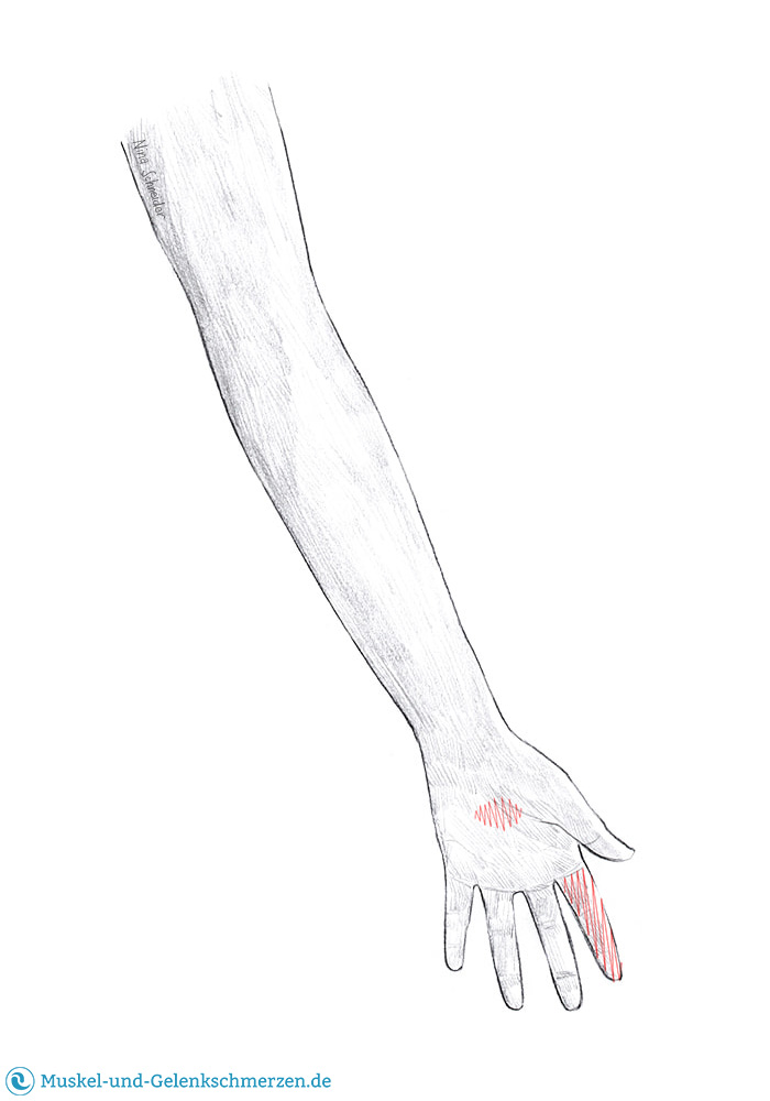 Interossei, Lumbricales und Abductor digiti Schmerzen und Triggerpunkte ...