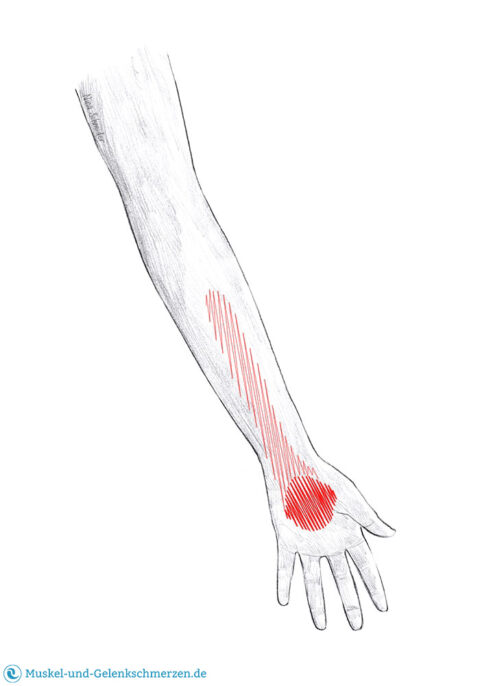 Palmaris longus Schmerzen und Triggerpunkte selbst behandeln