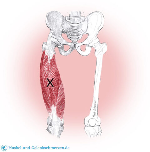 Quadriceps femoris Schmerzen & Triggerpunkte selbst behandeln