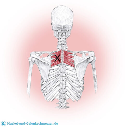 Serratus Posterior Superior Trigger Point Ep 328 The Serratus