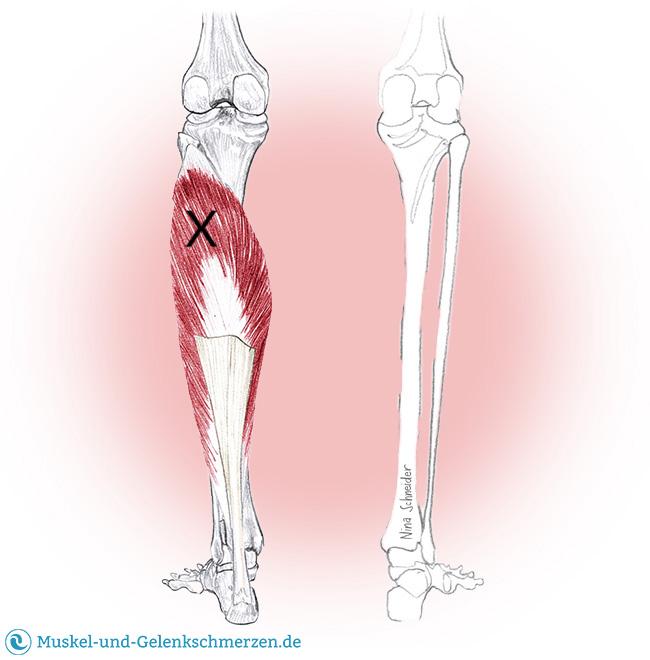 Soleus Schmerzen und Triggerpunkte selbst behandeln