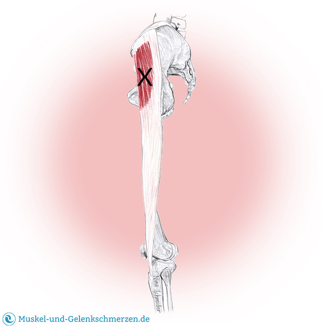 Tensor fasciae latae Schmerzen und Triggerpunkte selbst behandeln