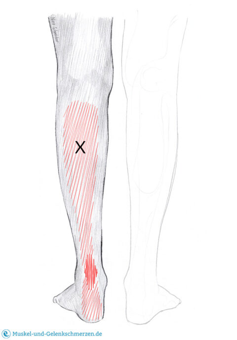 Posterior Tibialis Trigger Point Foot And Ankle Pain From Posterior