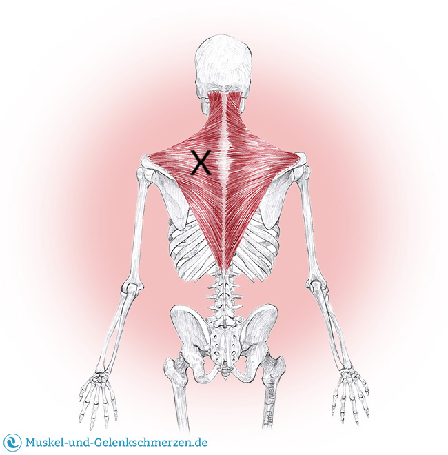 Trapezius Schmerzen und Triggerpunkte selbst behandeln