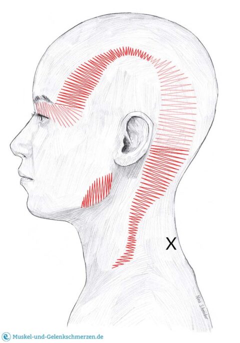 Trapezius Schmerzen und Triggerpunkte selbst behandeln