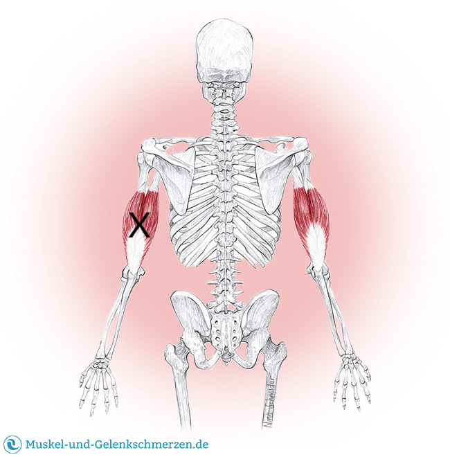 Trizeps Schmerzen und Triggerpunkte selbst behandeln