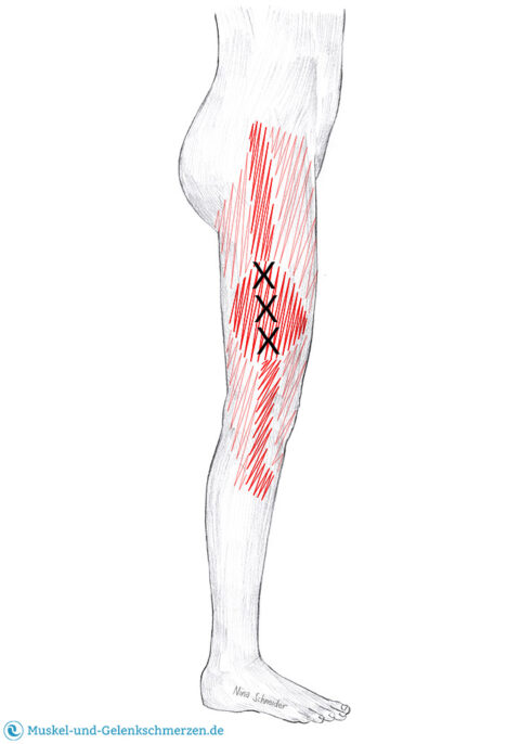 Quadriceps femoris Schmerzen & Triggerpunkte selbst behandeln