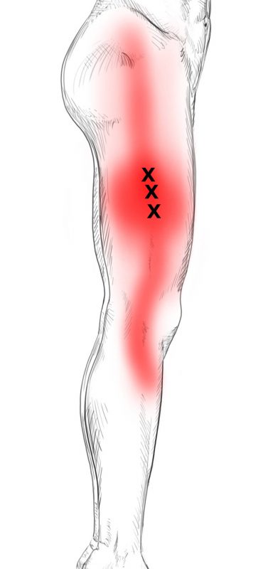 Vastus Lateralis The Trigger Point Referred Pain Guide | My XXX Hot Girl Vastus Lateralis The Trigger Point Referred Pain Guide | My XXX Hot Girl